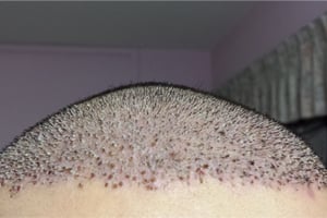 Scabs After a FUE Hair Transplant - Clinicana